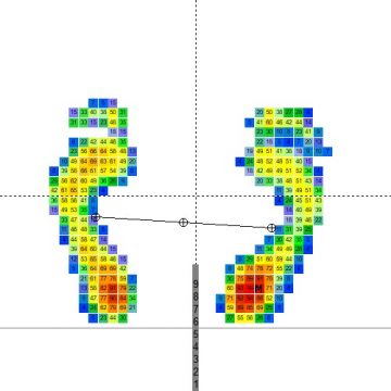 Foot Arch Classification via ML-based Image Classification: When AI can ...